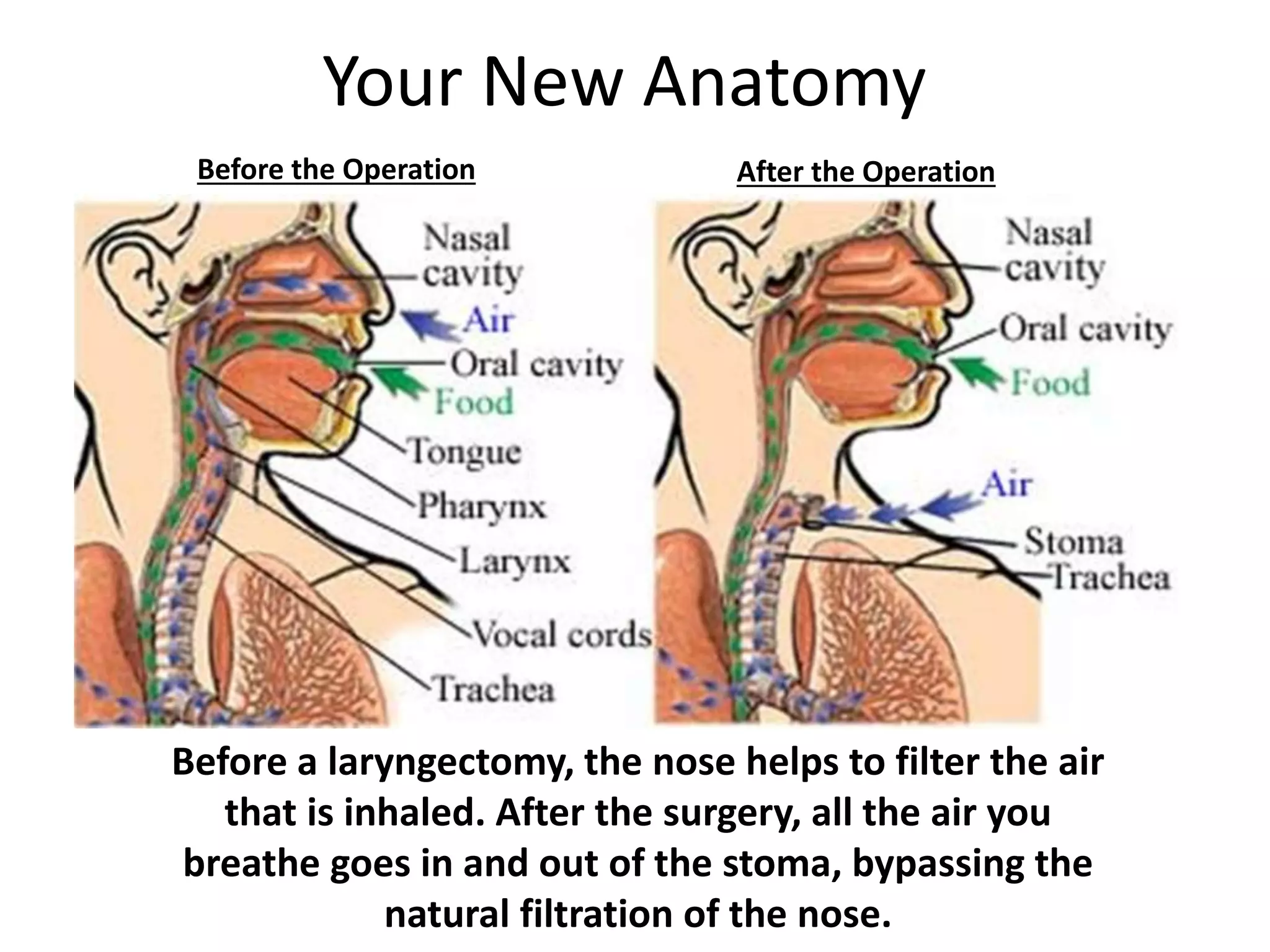 Laryngectomy[1][1] | PPTX