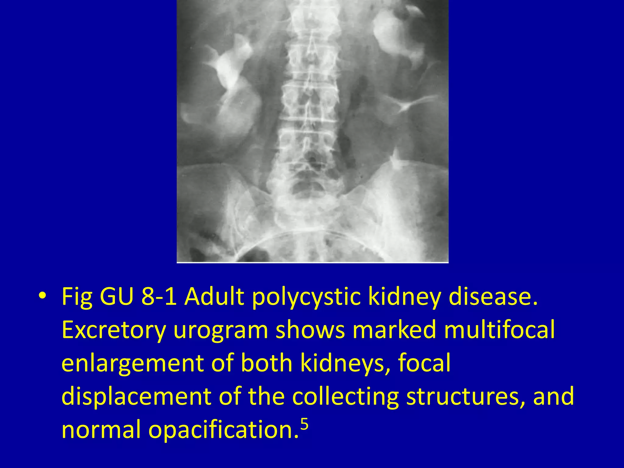 8 bilateral large, multifocal kidneys | PPTX
