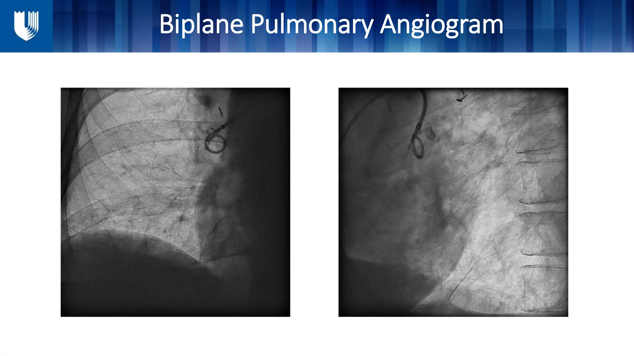CTEPH Surgical and BPA Treatment Update | PPTX
