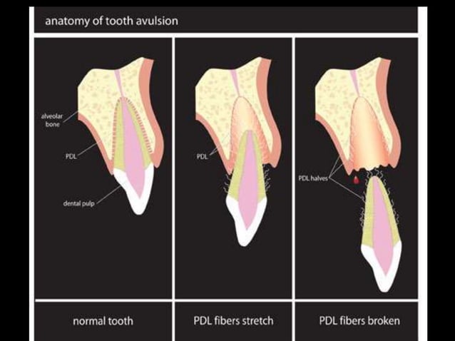 Avulsion of permanent teeth | PPTX