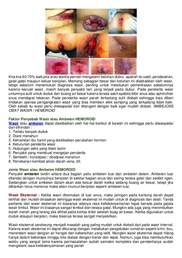 8 cara mengobati penyakit wasir