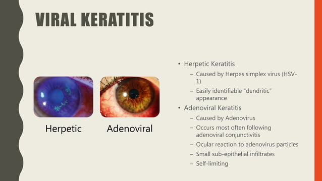 Keratitis | PPTX