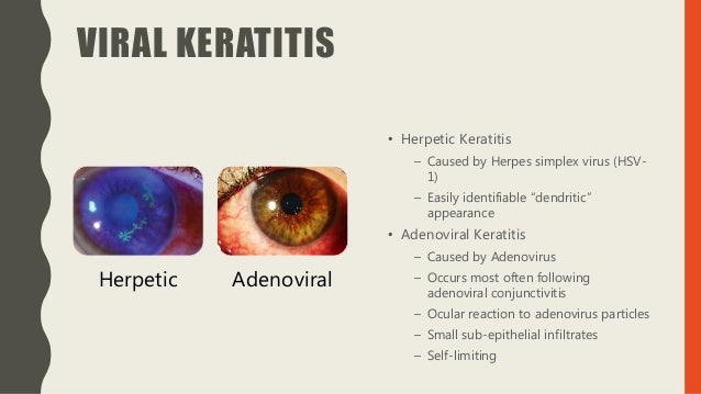 Keratitis