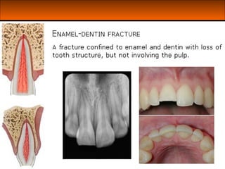 ΚΑΤΑΓΜΑ ΜΥΛΗΣ ΑΔΑΜΑΝΤΙΝΗΣ ΟΔΟΝΤΙΝΗΣ | PPT
