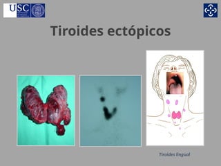Tiroides en sistema endocrino y glándulas paratiroides | PPTX