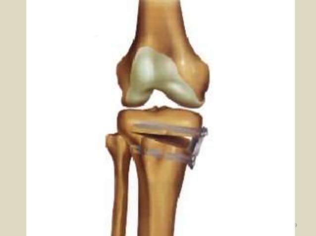 PPT OA Knee | PPTX
