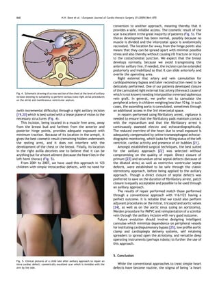 axillary repair of CHD | PDF