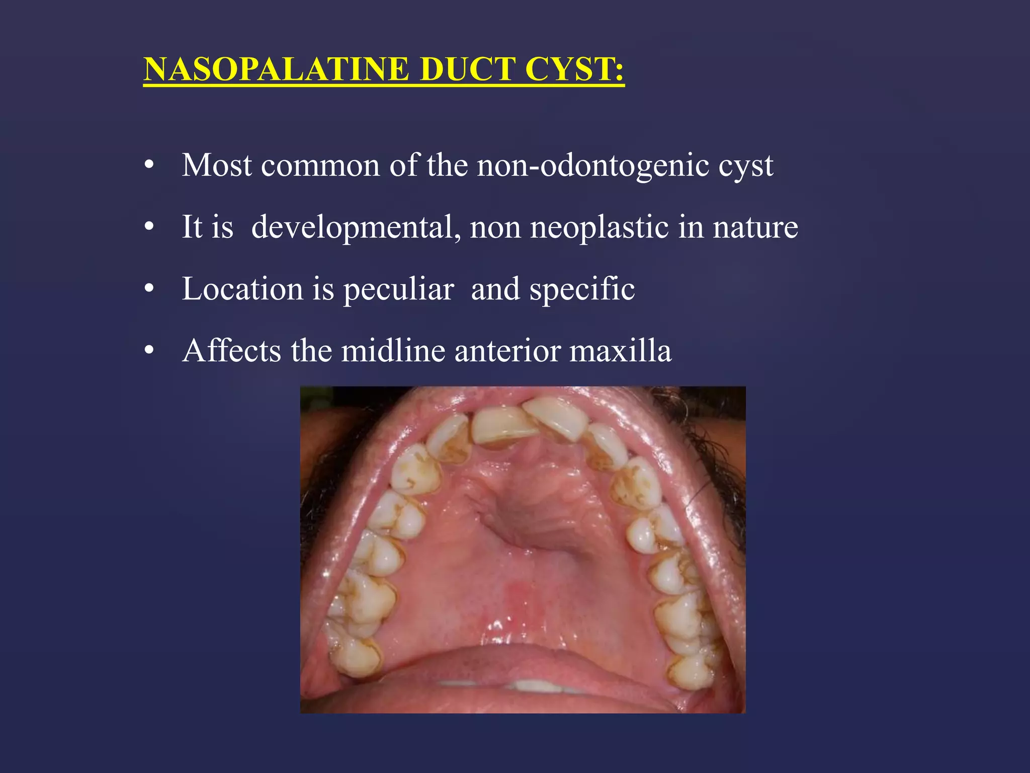 Fissural cysts of oral cavity | PPTX
