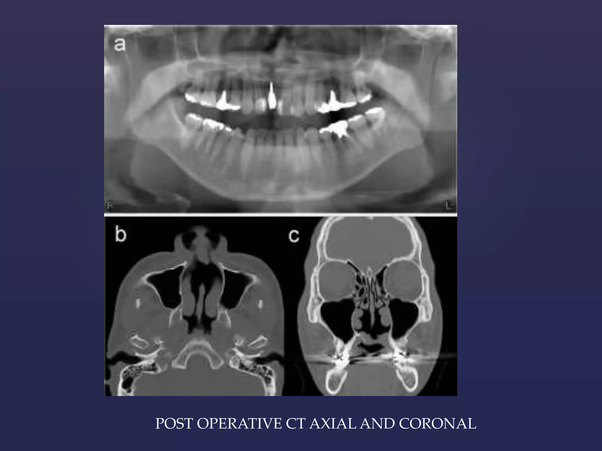 Fissural cysts of oral cavity | PPTX