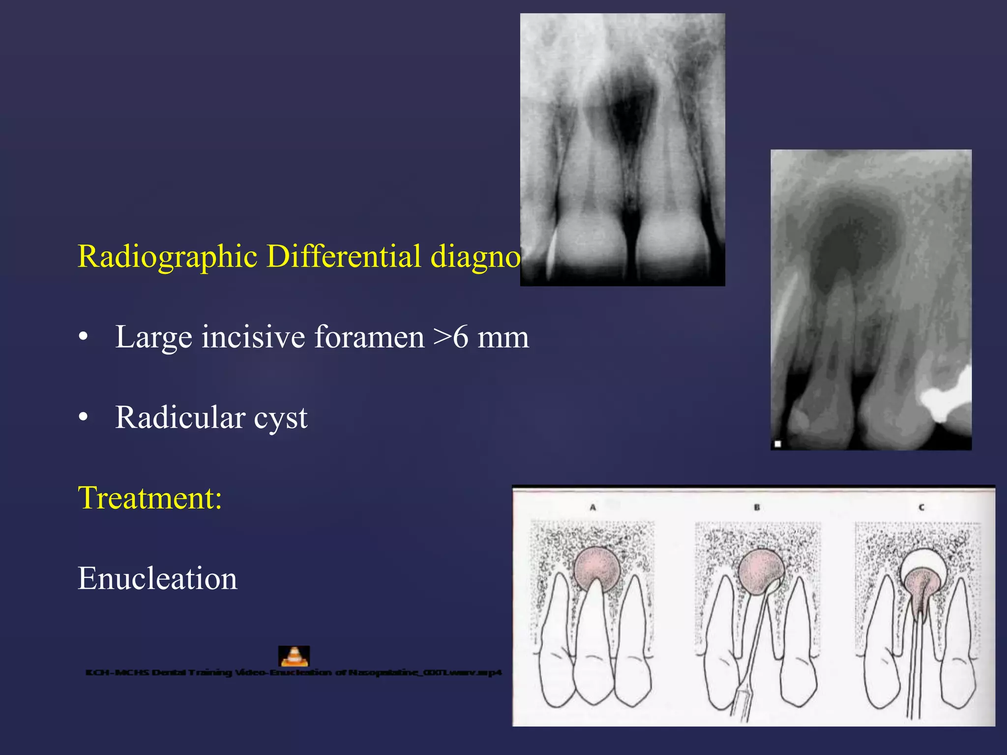 Fissural cysts of oral cavity | PPTX