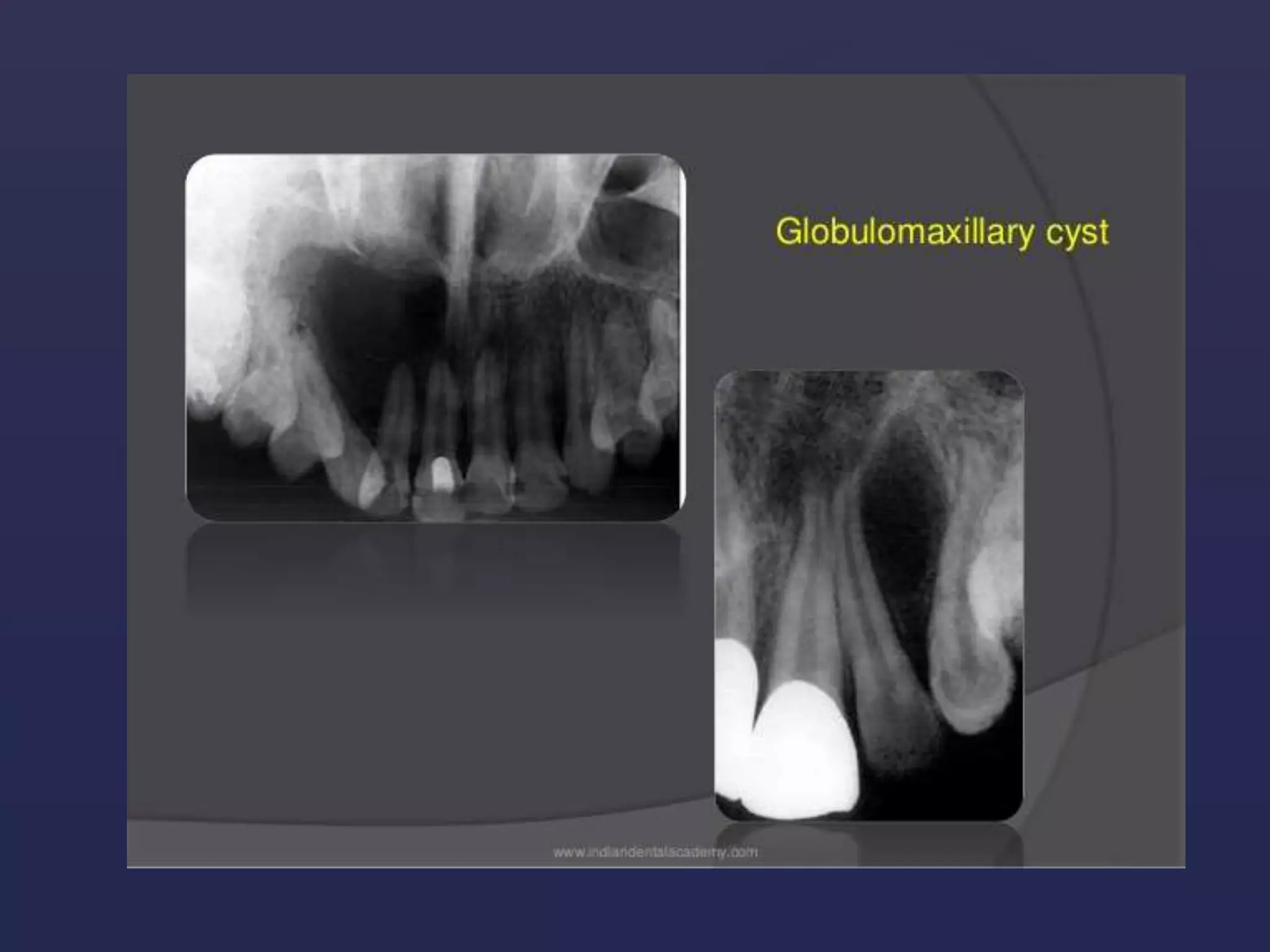 Fissural cysts of oral cavity | PPTX