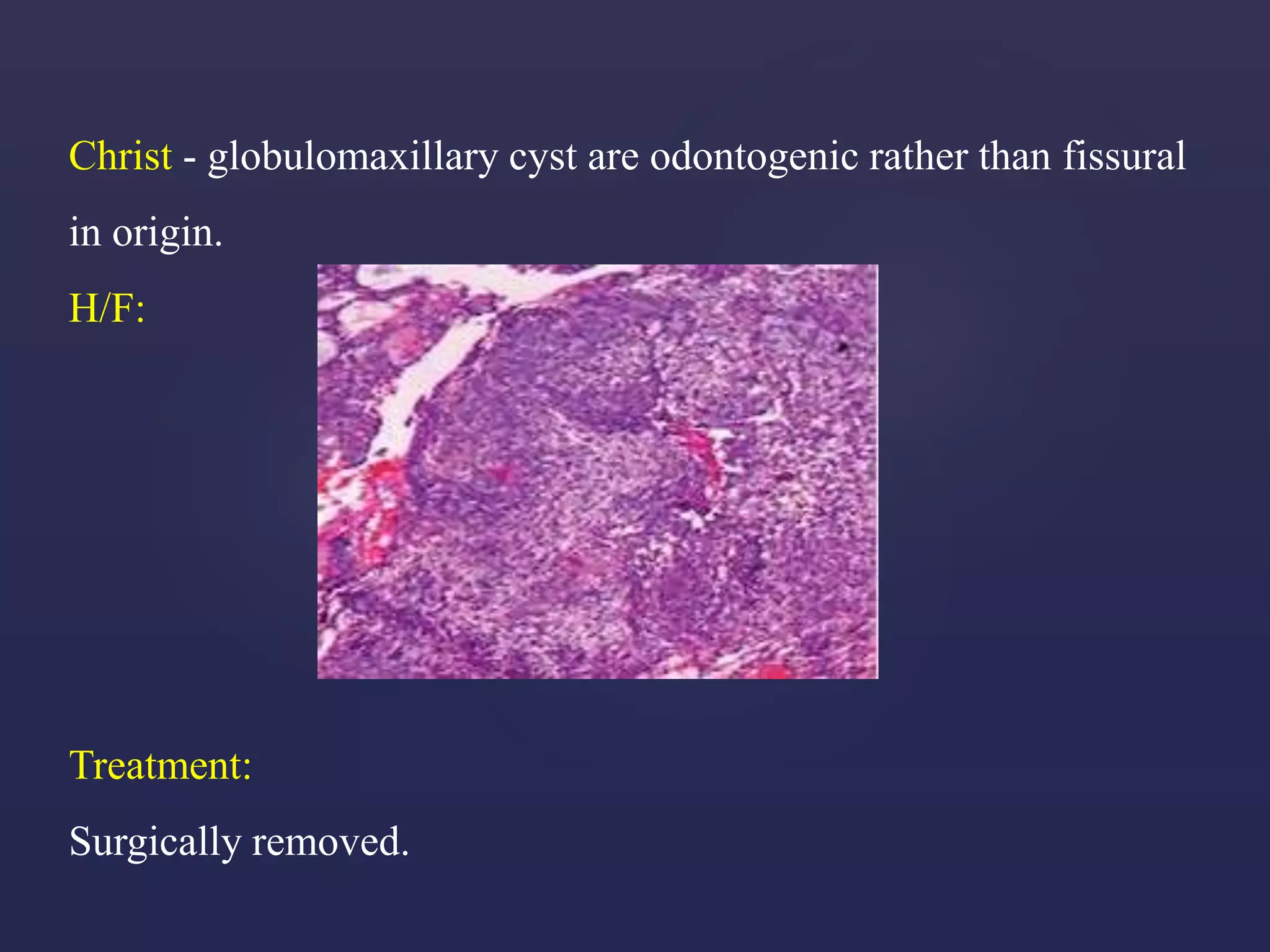 Fissural cysts of oral cavity | PPTX