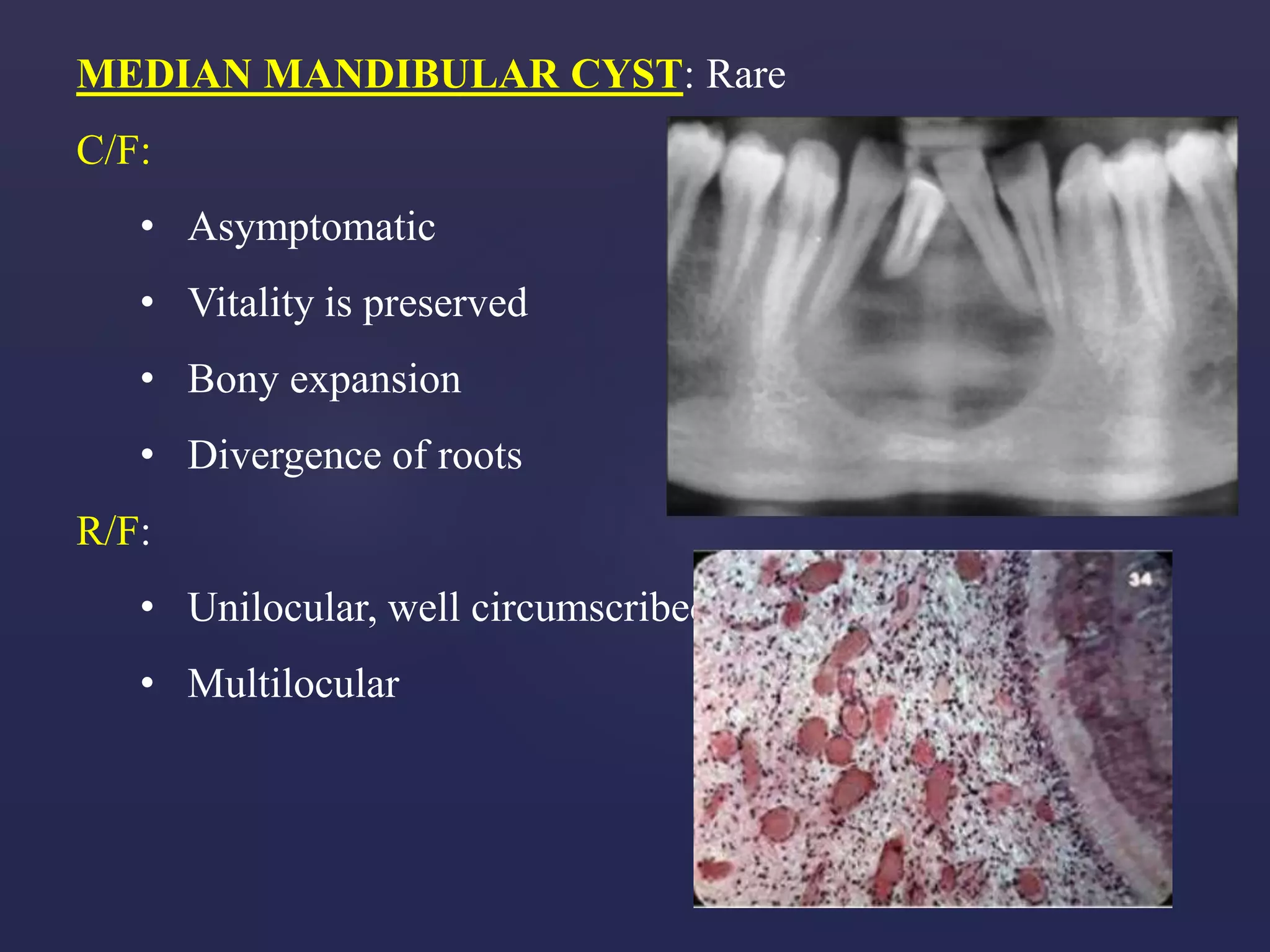 Fissural cysts of oral cavity | PPTX