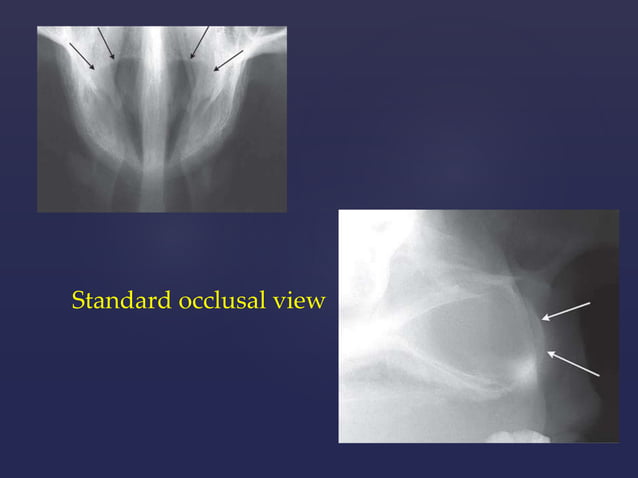 Fissural cysts of oral cavity | PPTX