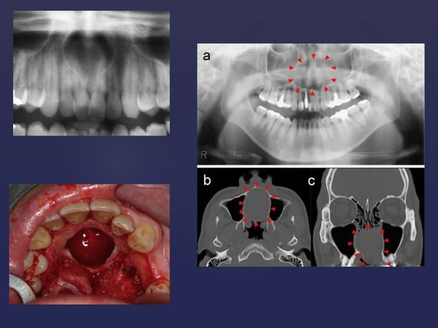 Fissural cysts of oral cavity | PPTX