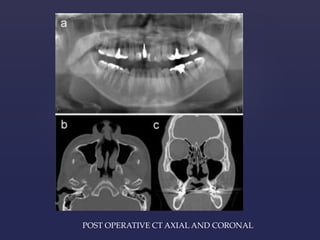 Fissural cysts of oral cavity | PPTX