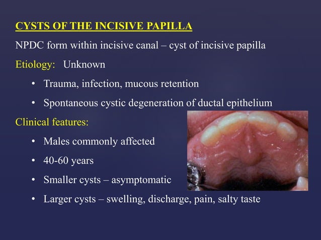 Fissural cysts of oral cavity | PPTX
