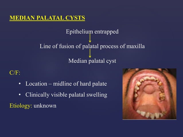 Fissural cysts of oral cavity | PPTX
