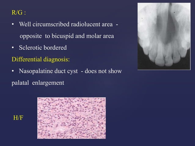 Fissural cysts of oral cavity | PPTX