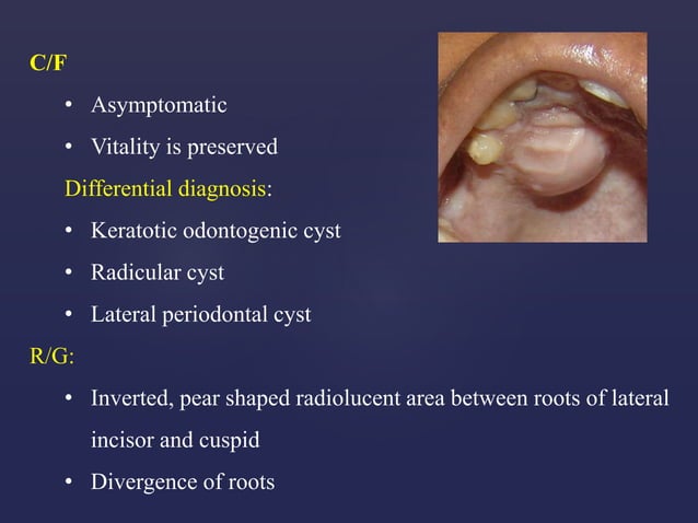 Fissural cysts of oral cavity | PPTX