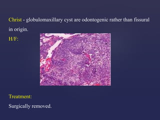 Fissural cysts of oral cavity | PPTX