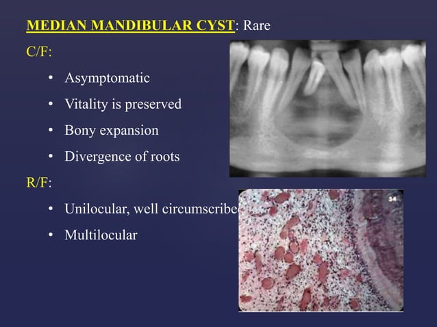 Fissural cysts of oral cavity | PPTX