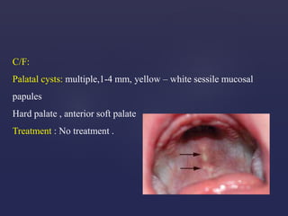 Fissural cysts of oral cavity | PPTX