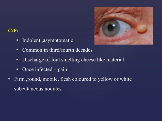 Fissural cysts of oral cavity | PPTX