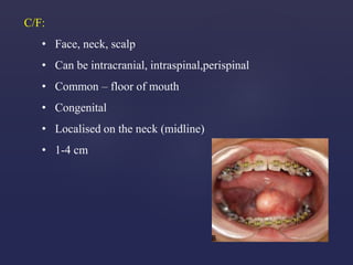 Fissural cysts of oral cavity | PPTX