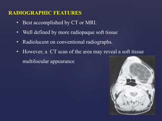 Fissural cysts of oral cavity | PPTX