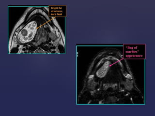 Fissural cysts of oral cavity | PPTX