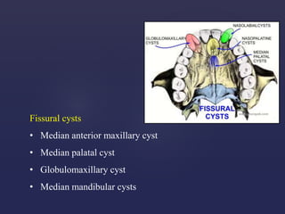 Fissural cysts of oral cavity | PPT