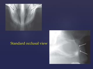 Bohns Nodules Radiograph