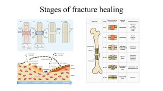 Introduction to fracture and its classification | PDF