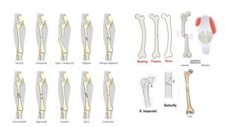 Introduction to fracture and its classification | PDF