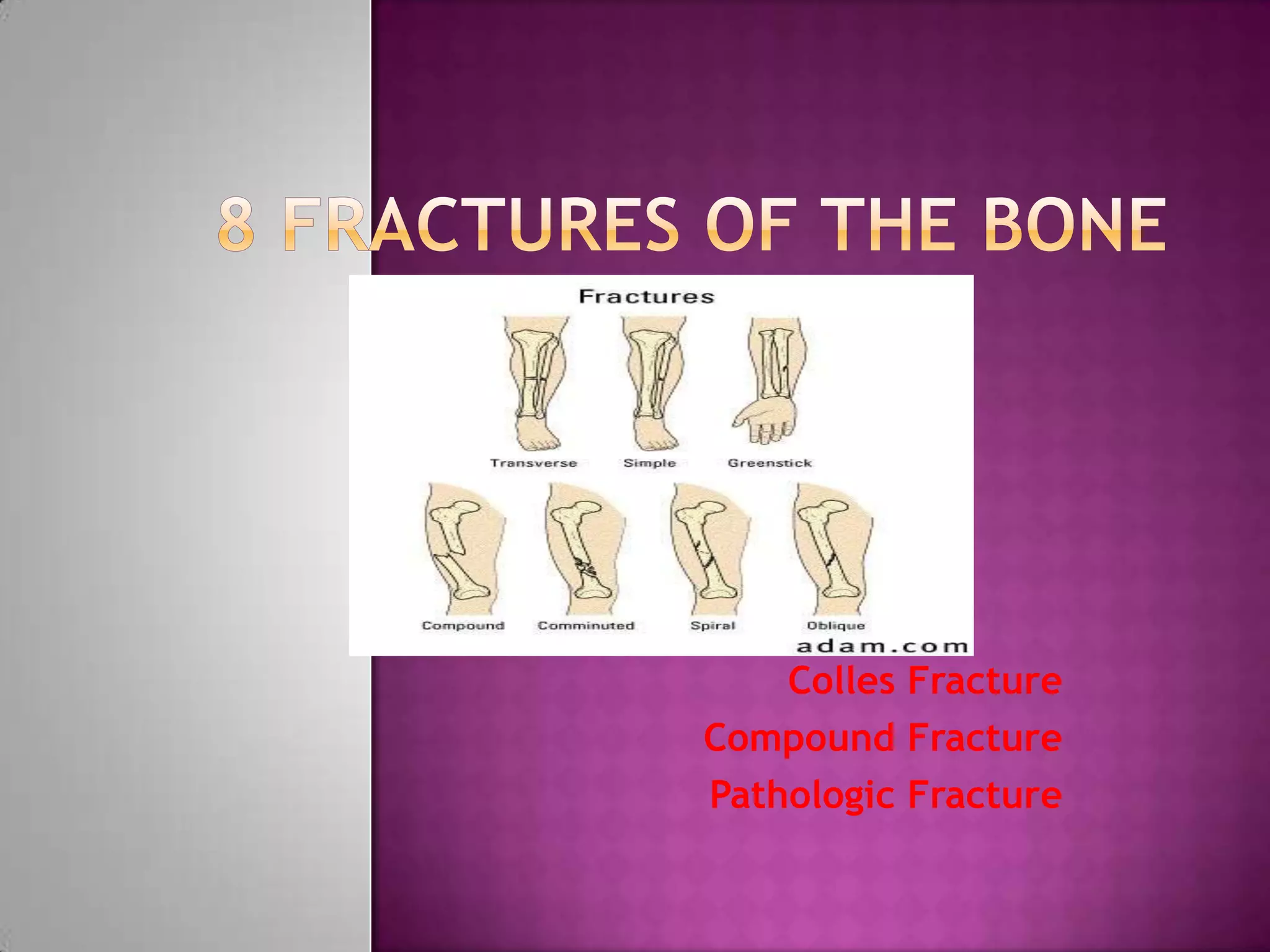 8 fractures of the bone | PPTX