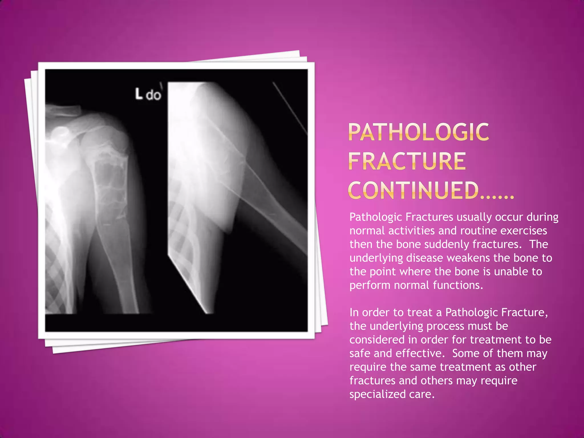8 fractures of the bone | PPTX