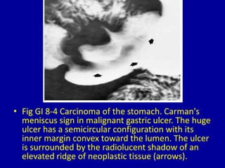 8 gastric ulceration | PPTX
