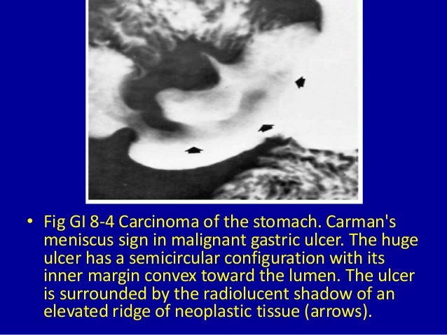 8 gastric ulceration