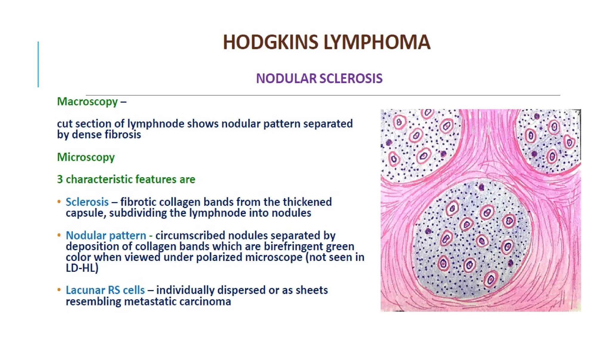 Hodgkins-lymphoma / disease Hematopathology.ppt