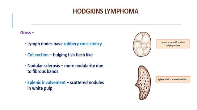 Hodgkins-lymphoma / disease Hematopathology.ppt
