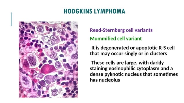 Hodgkins-lymphoma / disease Hematopathology.ppt