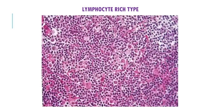 Hodgkins-lymphoma / disease Hematopathology.ppt