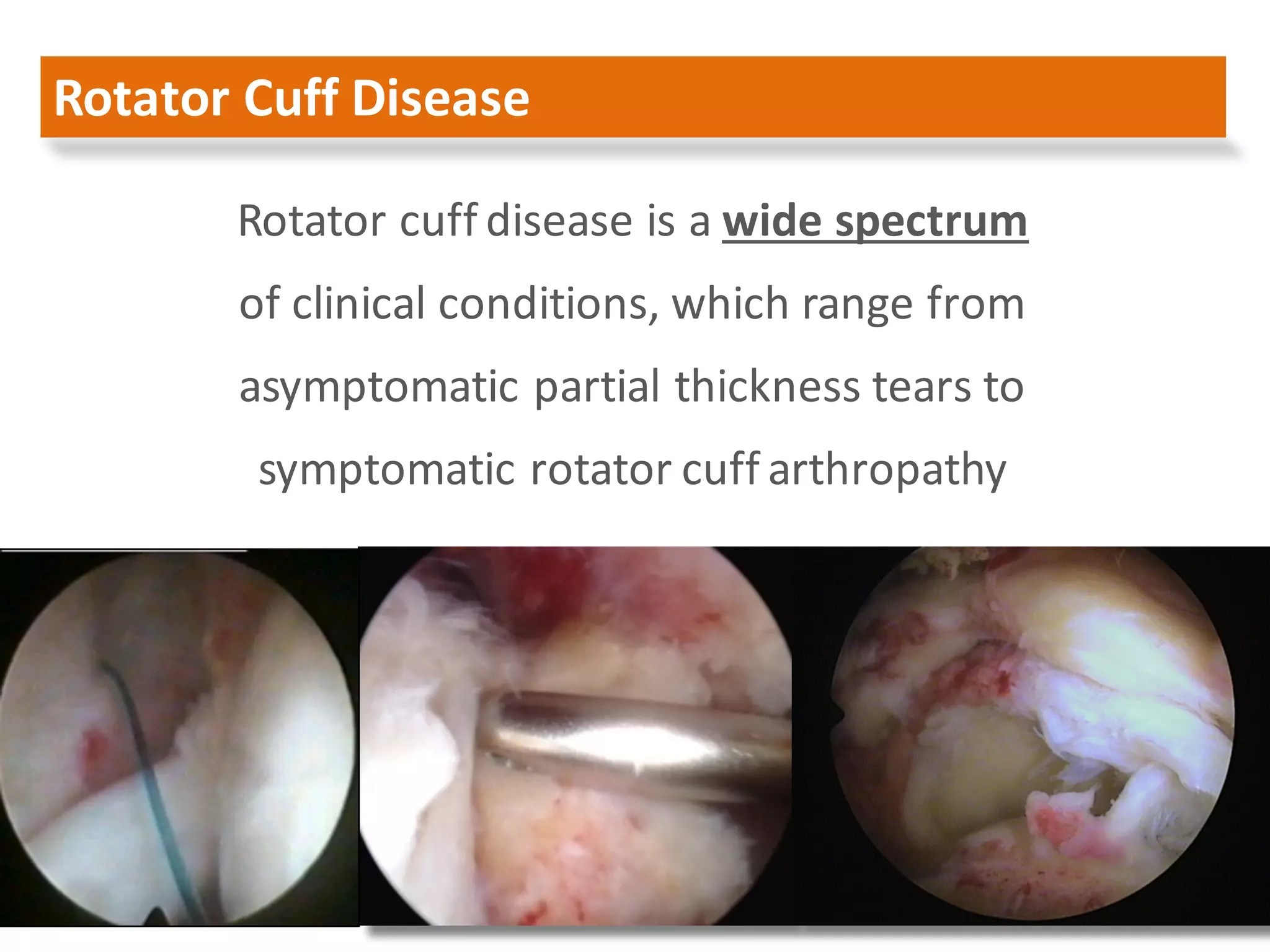 Arthroscopic management of rotator cuff tears larissa 2016 | PDF