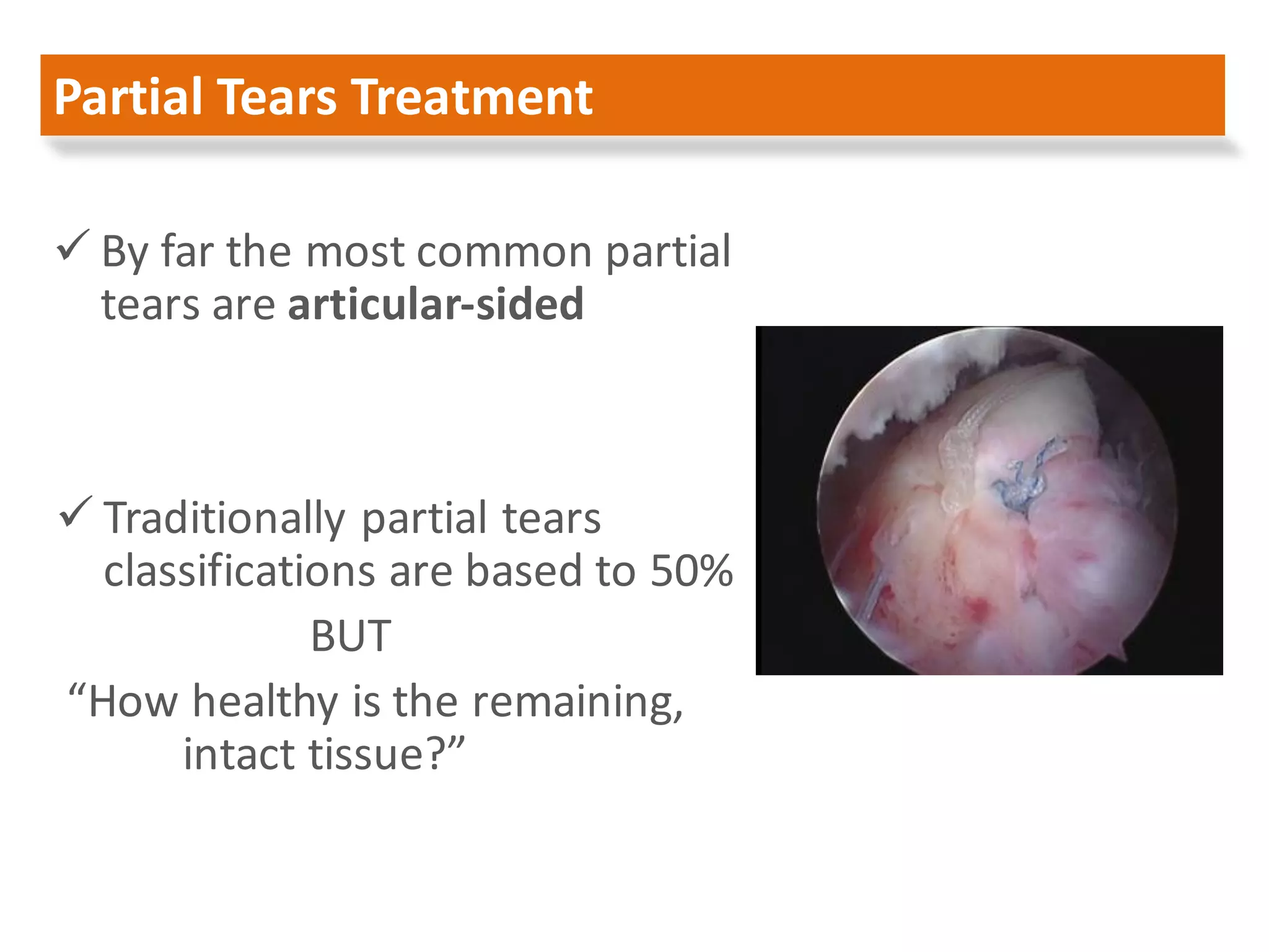 Arthroscopic management of rotator cuff tears larissa 2016 | PDF