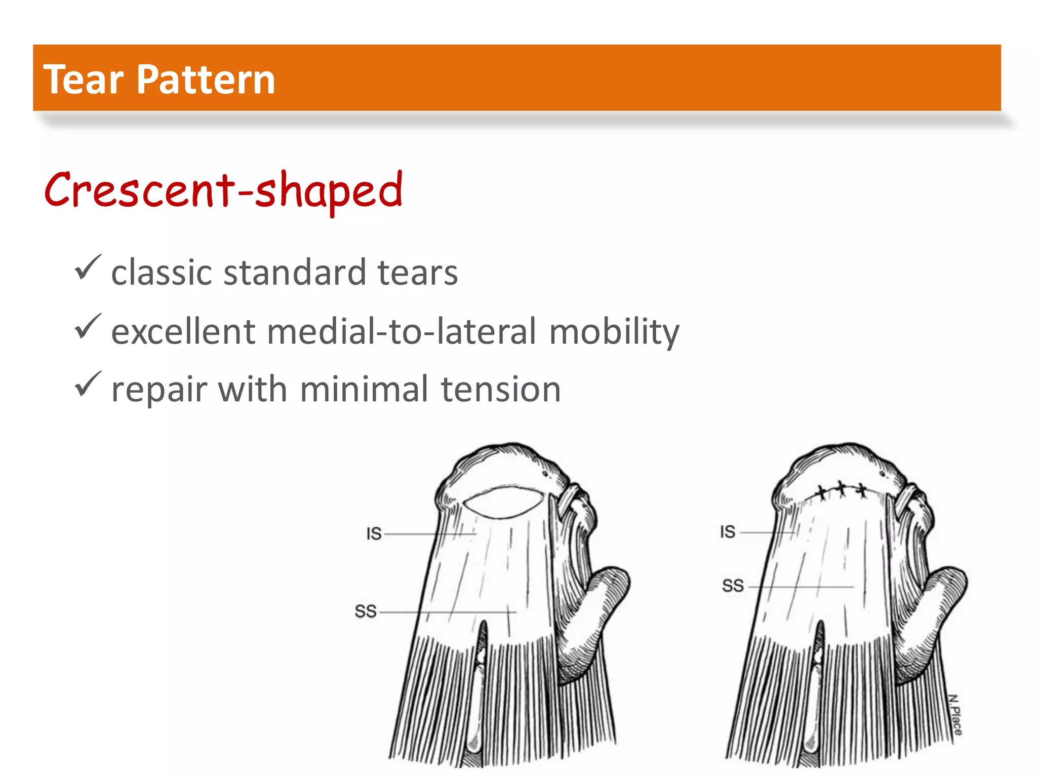 Arthroscopic management of rotator cuff tears larissa 2016 | PDF