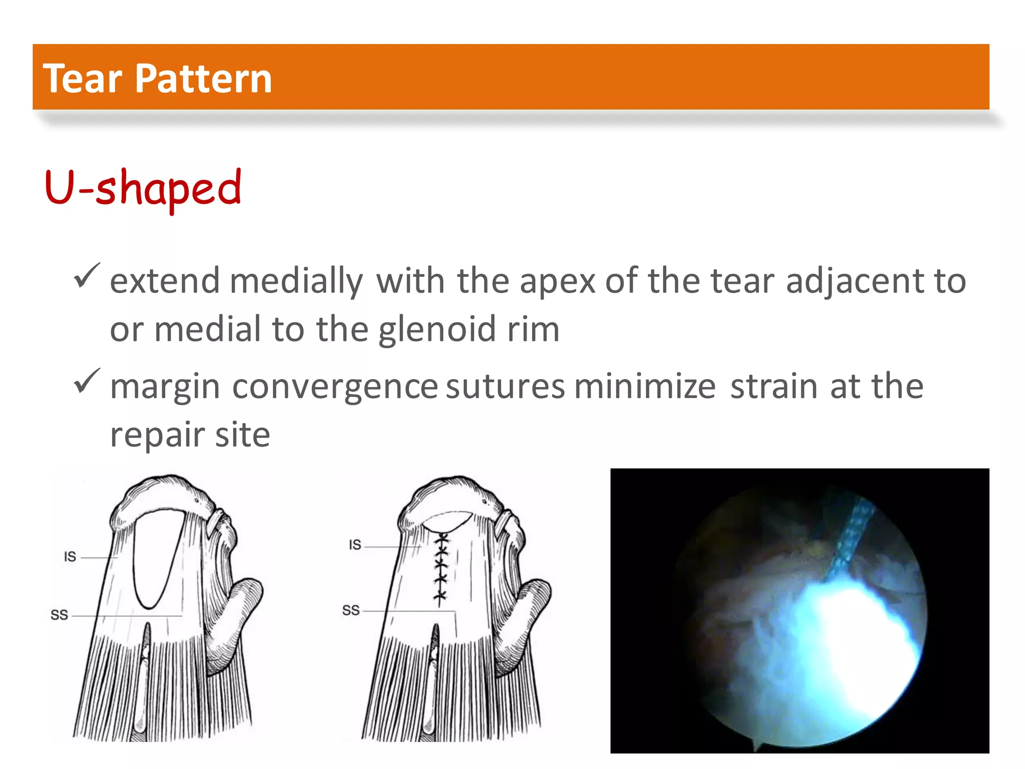 Arthroscopic management of rotator cuff tears larissa 2016 | PDF