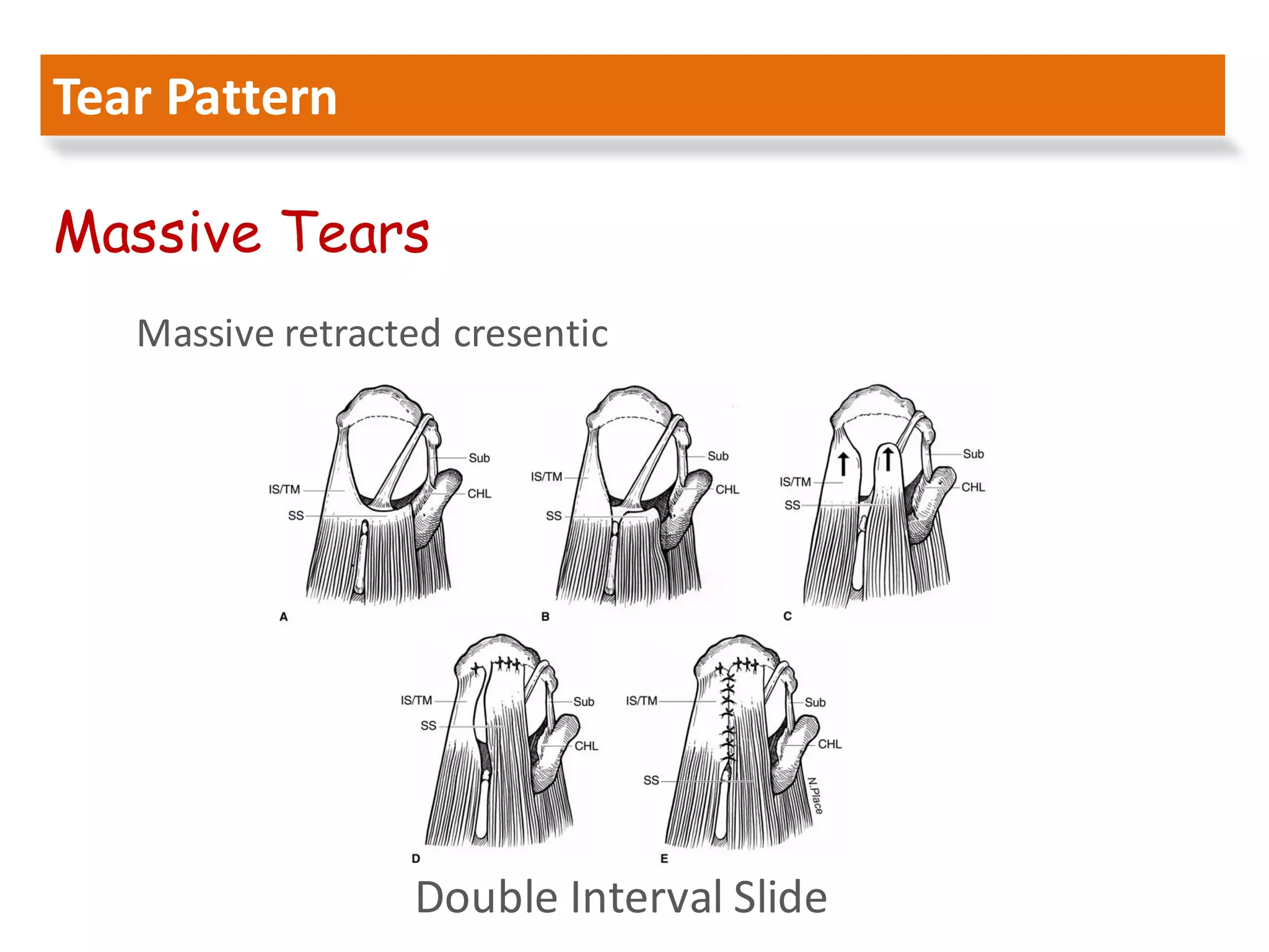 Arthroscopic management of rotator cuff tears larissa 2016 | PDF