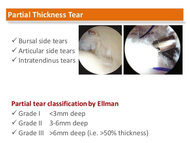 Arthroscopic management of rotator cuff tears larissa 2016