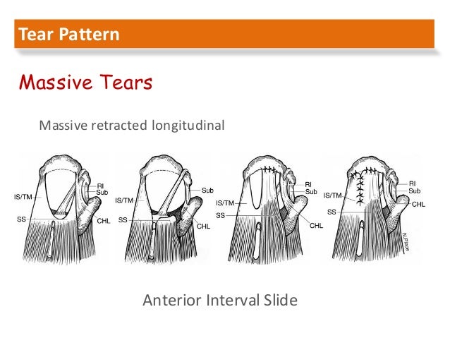 Arthroscopic management of rotator cuff tears larissa 2016